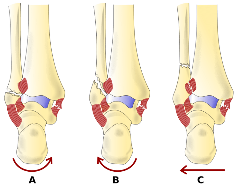 Agape Physiotherapy | Understanding The Types Of Weber Ankle Fractures ...