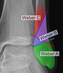Agape Physiotherapy | Understanding The Types Of Weber Ankle Fractures ...